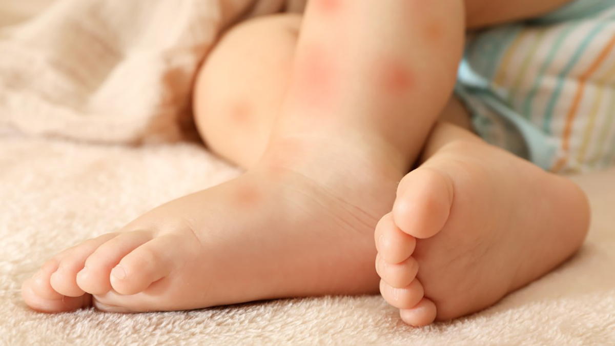 Alergista ensina como evitar picadas de insetos e explica reações ...